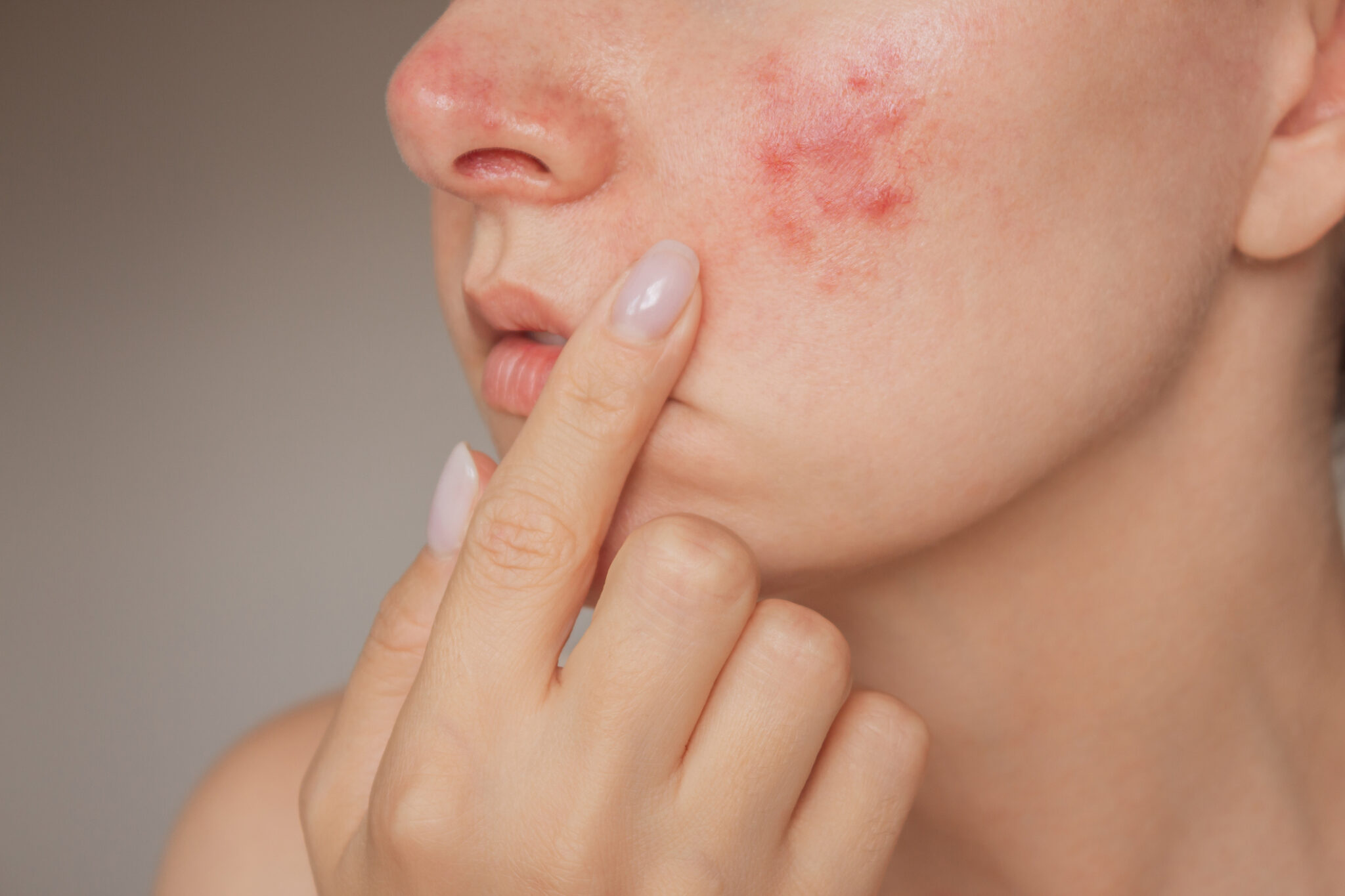 Acne: Types, Causes, Symptoms & Best Treatments